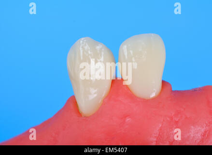 two tooth in the gum isolate in blue Stock Photo - Alamy