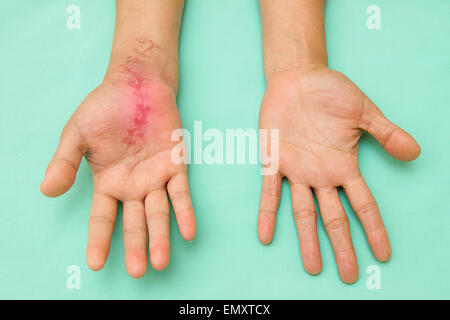 hand with suture scar after surgery on white background Stock Photo - Alamy