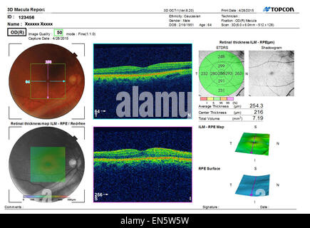 Eye scan ultra sound test showing 3D MACULA REPORT of human eye vist ...