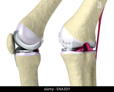 Knee and titanium hinge joint. Isolated on white Stock Photo - Alamy