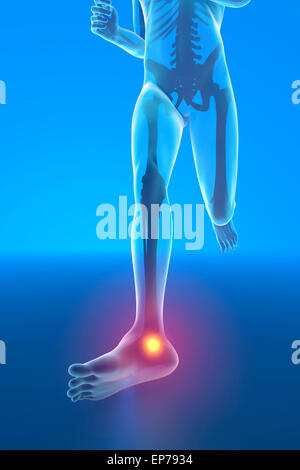 Sprained ankle blue x-ray with highlighted area on blue background ...