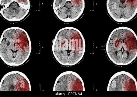 Ischemic stroke : ( CT of brain show cerebral infarction at left Stock ...
