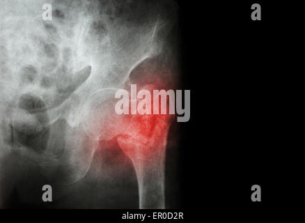 Intertrochanteric fracture femur ( thigh bone ). X-ray of hip and ...