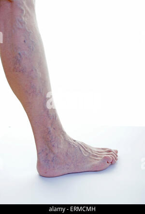 Varicose veins leg (female, age 68 years) / Krampfadern Varizen am Bein ...