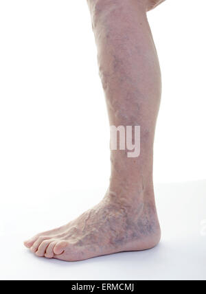 Varicose veins leg (female, age 68 years) / Krampfadern Varizen am Bein ...