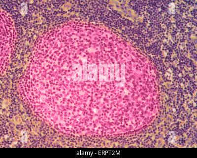 Lymph node. Coloured light micrograph of a section through a lymph node ...