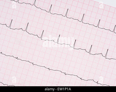 Healthy heart etc. Electrocardiogram ecg printout detail with note for ...