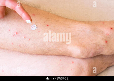 Drug allergy. Rash on the legs of an 80-year-old man caused by an ...