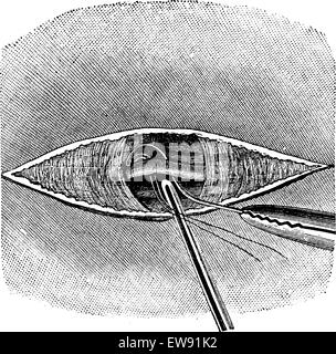 ligature, medical equipment, surgical instrument, history of medicine ...