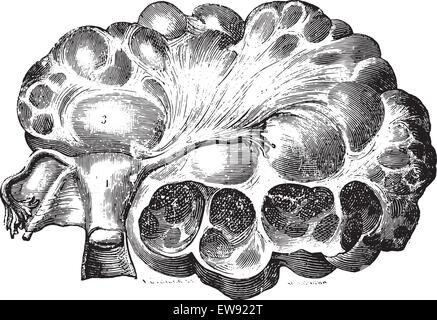 OVARIAN CYST, DRAWING Stock Photo - Alamy
