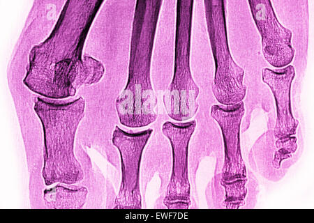 Hallux Valgus or bunion x-ray 3D rendering illustration. Dorsal or top ...