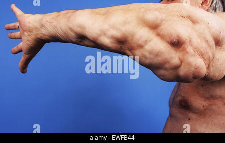 Benign fatty tissue tumour (lipoma, lump at centre) on a 28-year-old ...