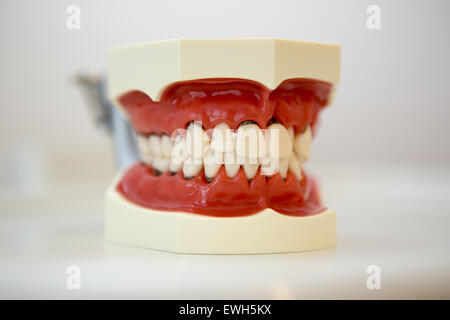 Berlin, Germany, a model set of teeth with periodontitis Stock Photo ...