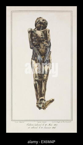 Decomposition On Exhumed Bodies, 1831 Stock Photo - Alamy