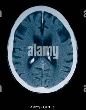CT scan of an 84 year old man with Alzheimer's disease. CT shows brain ...