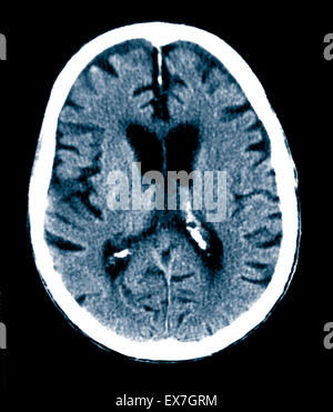 CT scan of an 84 year old man with Alzheimer's disease. CT shows Stock ...