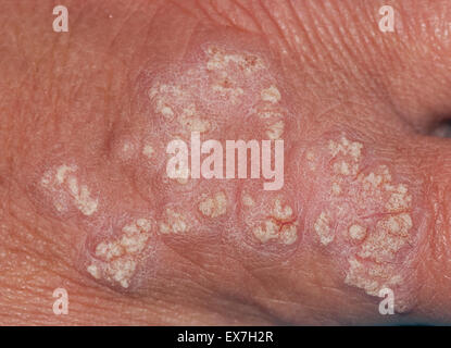 Hand lesions showing inflammatory linear verrucous epidermal nevus ...