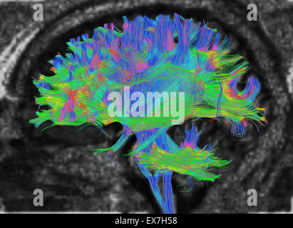 Fiber tractography image of the human brain Stock Photo - Alamy