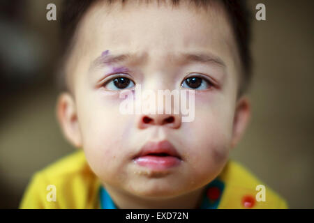 Boy with bruise Stock Photo - Alamy
