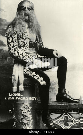 Lionel, The Lion-faced Boy Stock Photo - Alamy