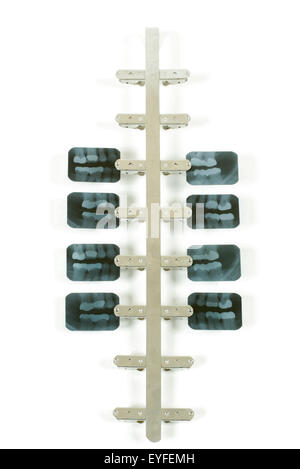 The dental bitewing x-ray film holder positions the x-ray in the ...