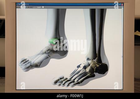 Orthopedic Institute Galeazzi (Milan, Italy), prosthesis for the ...