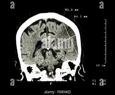A CT brain scan of a patient with large brain abscesses in her left ...