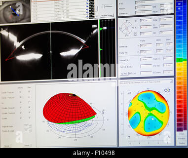 CORNEAL TOPOGRAPHY RESULT Stock Photo - Alamy