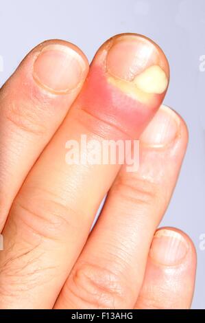Hand or finger infection detail Stock Photo - Alamy