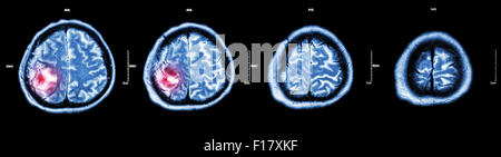 Brain tumor ( Film CT-scan of brain : show part of brain with tumor ...