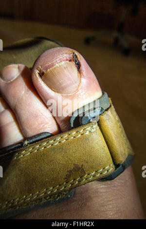Big toe with damaged bleeding nail plate close-up Stock Photo - Alamy