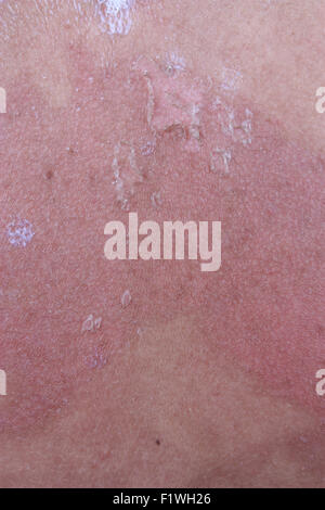 Example sunburn heat burning rash skin Stock Photo - Alamy