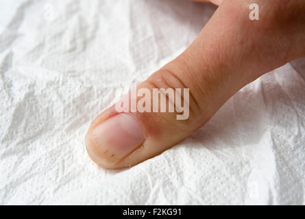 Splinter Haemorrhage on Fingernail Stock Photo - Alamy