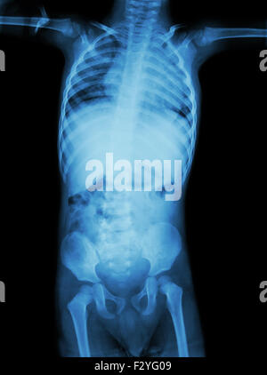 X-ray of pediatric chest abdomen and pelvis Stock Photo: 9206203 - Alamy