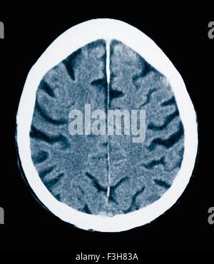 CT scan 84 year old male with Alzheimer's disease. CT shows brain ...