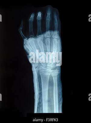 X-Ray image of human hand for fracture Stock Photo - Alamy