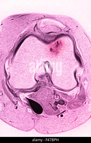 OSSEOUS EDEMA MRI Stock Photo - Alamy