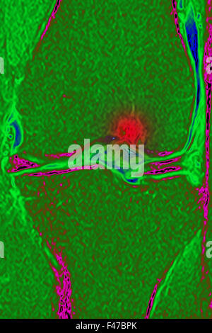 OSSEOUS EDEMA MRI Stock Photo - Alamy