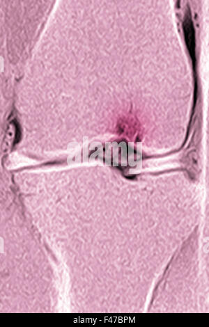 OSSEOUS EDEMA MRI Stock Photo - Alamy