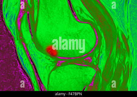 OSSEOUS EDEMA MRI Stock Photo - Alamy