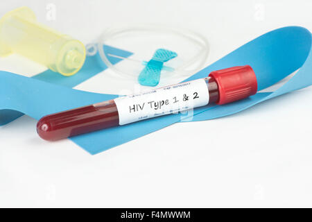 Sample blood collection tube with HIV test label on HIV infection ...
