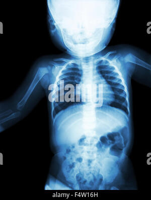 Film x-ray child 's body ( normal baby Stock Photo - Alamy