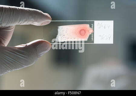 Blood smeared on a glass slide for diagnosis, held against the light in ...