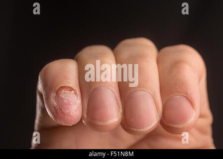 An adult male hand with a missing fingernail Stock Photo - Alamy