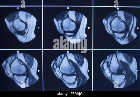 MRI magentic resonance imaging nuclear scanning scan test results foot ...