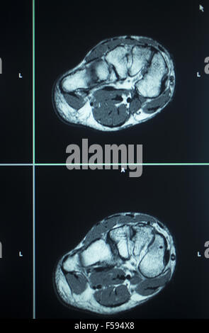 MRI magentic resonance imaging nuclear scanning scan test results foot ...