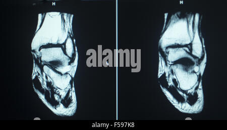MRI magentic resonance imaging nuclear scanning scan test results foot ...