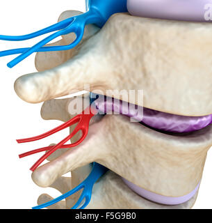 Spinal cord under pressure of bulging disc. Xray view. Medically ...