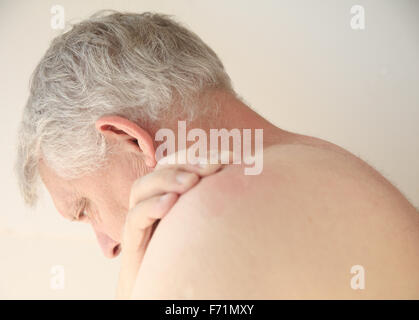 allergy rash on back of man isolated on white Stock Photo - Alamy