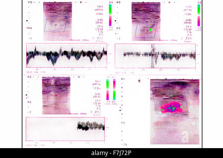 VENOUS DOPPLER TEST Stock Photo - Alamy